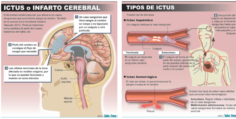 Ictus isquémico o hemorrágico ¿qué diferencia hay? - Fisioterapia a domicilio Alicante